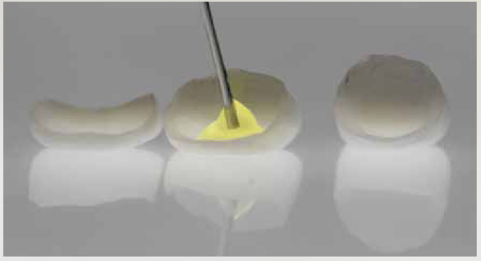 Carilla estratificada feldespatica – Porcelab
